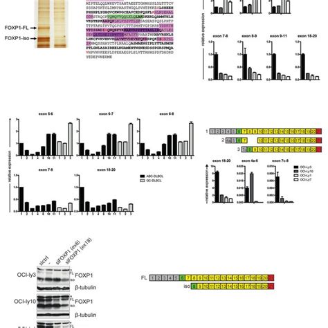 A Small Foxp1 Isoform Is Highly Expressed In Abc Dlbcl Patients And