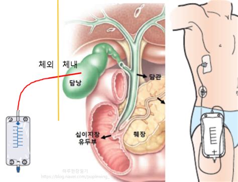 Gb Cbd Stone Cholecystition Cholangitis 간호사가 알아야 할 Ercp A7
