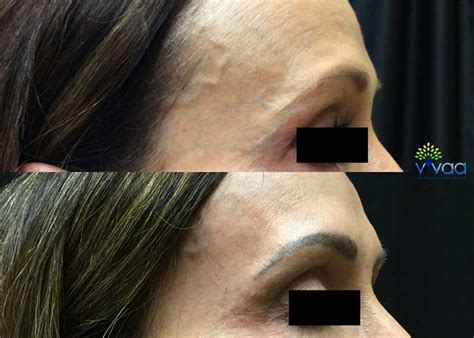 Protruding Forehead Vein