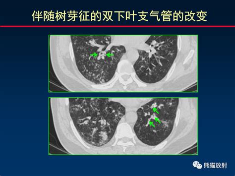壹生资讯 今日技能一文掌握支气管病变ct征象