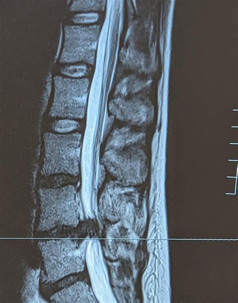 Numb Foot Freaking Me Out Rsciatica