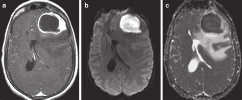 24 Bacterial Abscess A Axial Contrast Enhanced T1 B Dwi And C