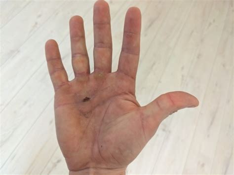 Lifting Calluses Armor For Your Hands Garage Gym Revisited