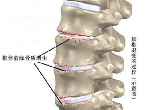 三种食物 吃走”骨刺，老少皆宜，不复发！朋友圈已转疯