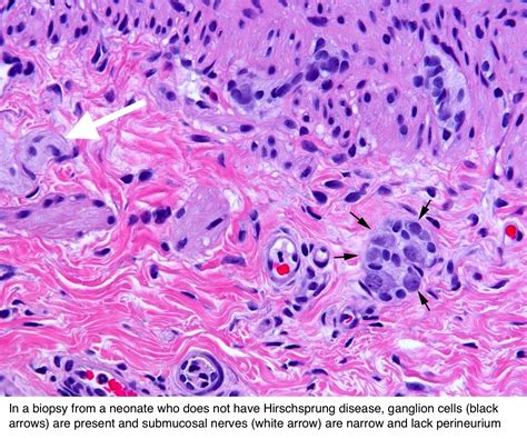 Pathology Outlines Hirschsprung Disease