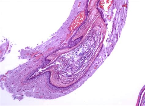 Epidermoid Cyst Histology Epidermoid Cyst Medical Pictures Info