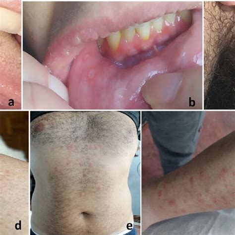 Mucocutaneous Manifestations In Behcets Disease Minor Oral Ulcer With