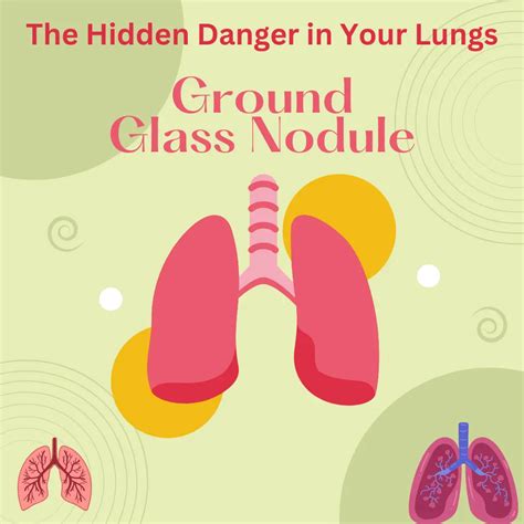 Ground Glass Nodule The Hidden Danger In Your Lungs Healthfness