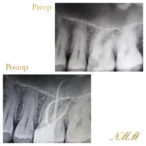 Nermeen Moussa On Linkedin Triple Curves 🦷 Tooth 14 26 Chief