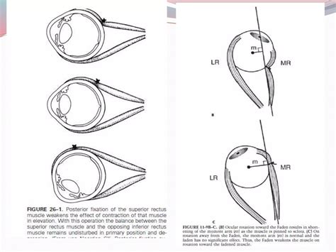 Principles Of Strabismus Surgery Ppt