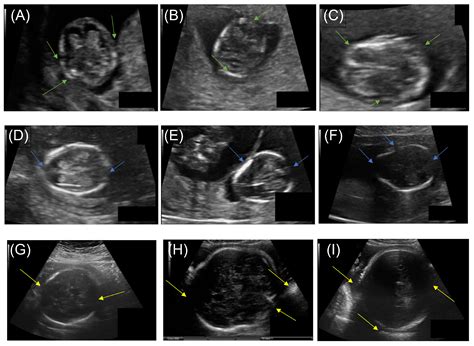 Ensemble Transfer Learning For Fetal Head Analysis From Segmentation To Gestational Age And