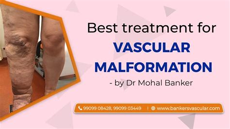 Best Treatment For Vascular Malformation Absolute Ethanol Embolization