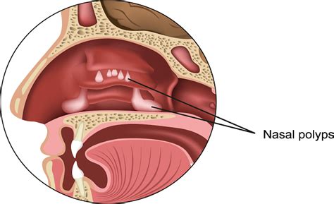 Causes Symptoms And Diagnosis Of Nasal Polyps