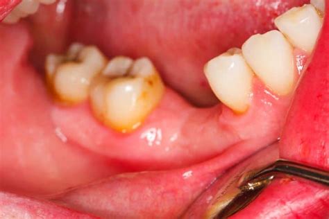 Teeth Extraction For Braces Do I Need To Remove Teeth For Orthodontic