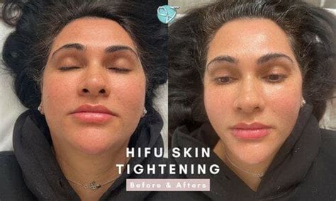 Endolift Before And After Vie Aesthetics
