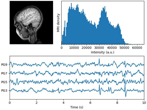 Mri With Eeg — Matplotlib 3101 Documentation