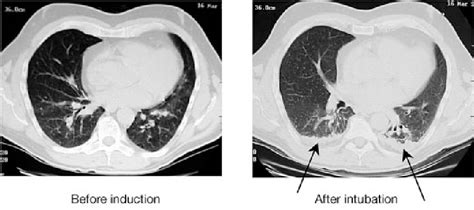 Figure 1 From New Concepts Of Atelectasis During General Anaesthesia