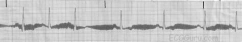 Types Of Ecg Artifacts Understanding Interference