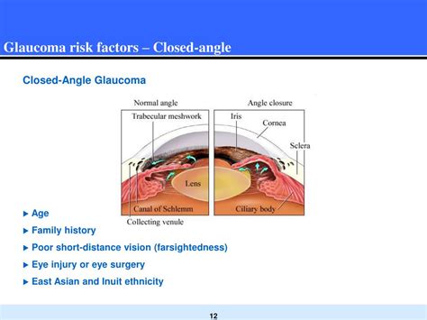 Ppt Glaucoma Information Powerpoint Presentation Free Download