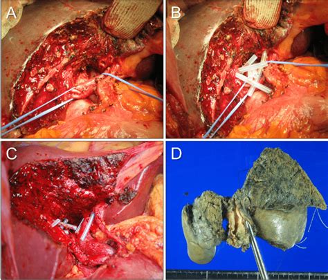 Intraoperative Intraoperative Photographs Showing Resection Of The Download Scientific Diagram