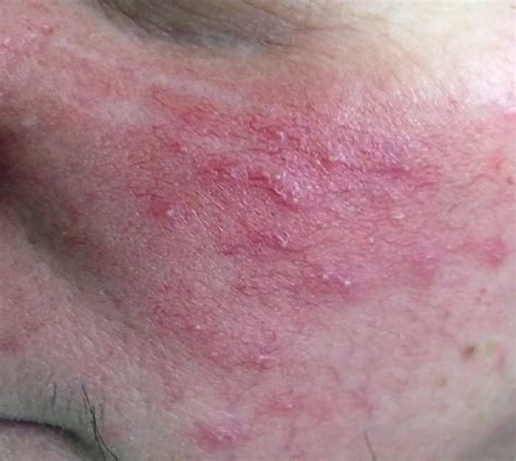 Papulo Pustular Rosacea Download Scientific Diagram