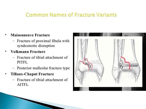 Ankle Fractures Final
