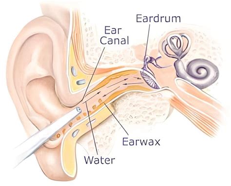 Ear Irrigation Tbt Aesthetics
