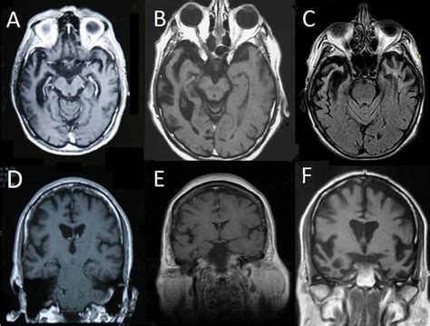 Representative Magnetic Resonance Imaging Mri Scans Of 6 Patients