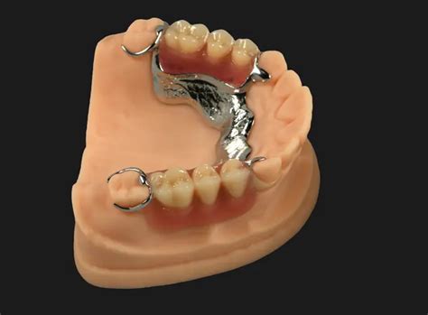 Partial Dentures With Metal Clasps Golden Smile Dental Lab