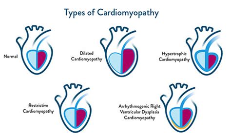 Types Of Cardiomyopathy Pdf Nouvelle Classification Des