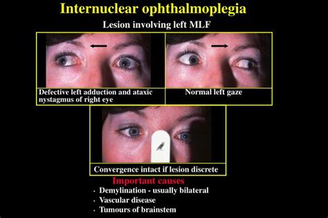 Ppt Supranuclear Disorders Of Eye Movement Powerpoint Presentation