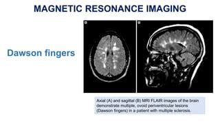 Multiple Sclerosis Introduction Risk Factors Diagnosis And Treatment