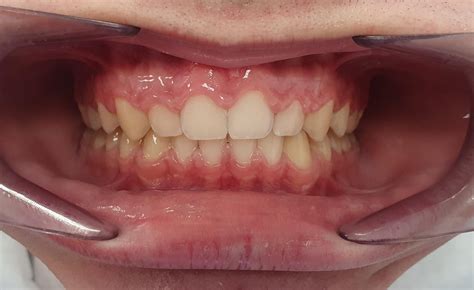 Braces Off After 20 Months R Braces