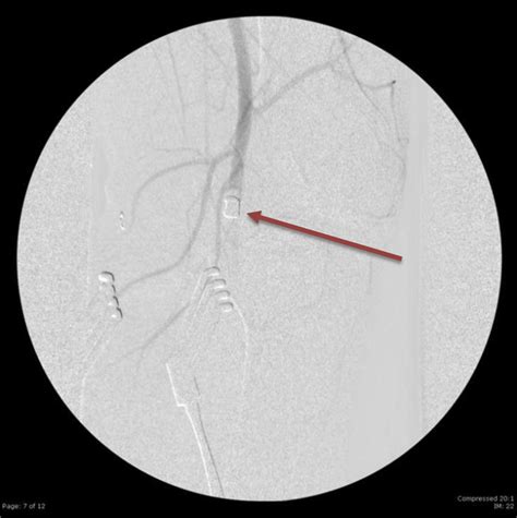 E Intraoperative Left Lower Extremity Arterial Angiogram At The Level Download Scientific