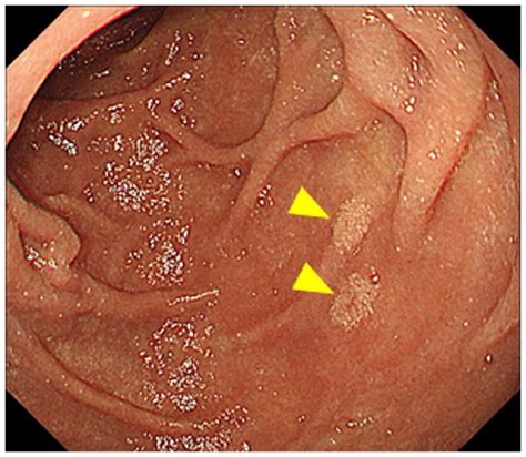 Endoscopic Findings In The Duodenum The Image Shows A Yellowish Fine