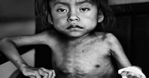 Yohan Flores La Desnutrición En El Zulia