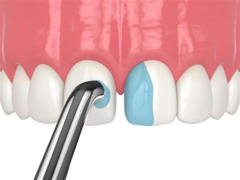 Tooth Bonding A Comprehensive Guide To Dental Bonding And Cosmetics