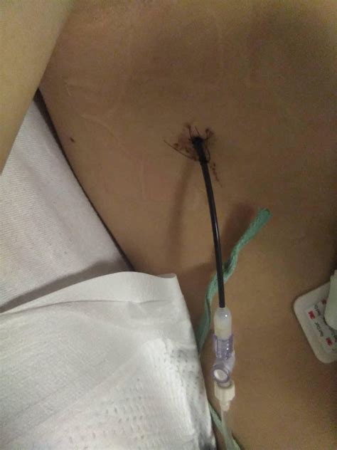 Pics From My Botched Pacemaker Implant Hematoma Collapsed Right Lung R Botchedsurgeries