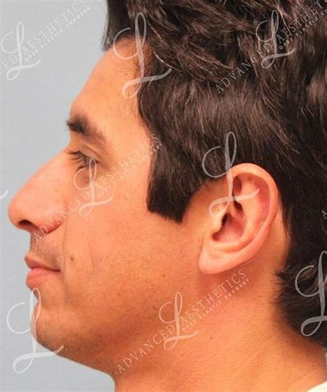 Otoplasty 3 Advanced Aesthetics Lopez Plastic Surgery