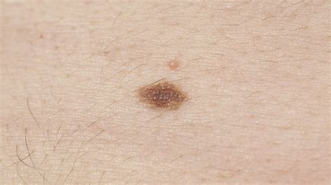 Melanoma Early Stages At Timothy Arrington Blog