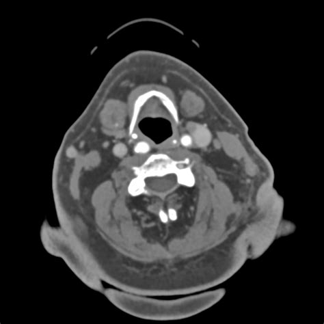 Radiopaedia Case Traumatic Vertebral Artery Dissection Id 48493 Study