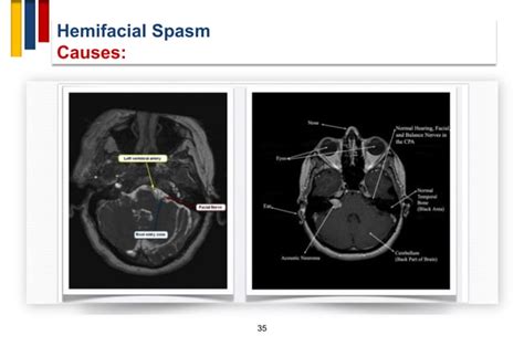 Hemifacial Spasm Pdf