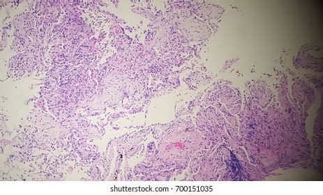 Lung Hemorrhage Images Stock Photos Vectors Shutterstock