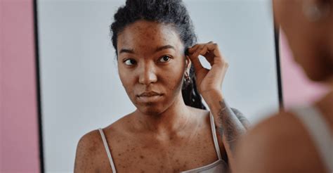 Living With Prurigo Nodularis Nowincluded