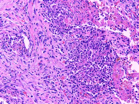 Langerhans Cell Histiocytosis Icd 10