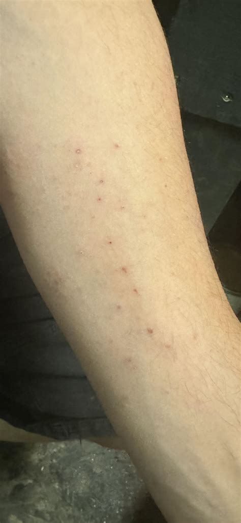 Scabies On Arms Human Scabies And Skin Mites Idatb