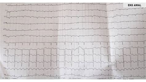 Halaman Unduh Untuk File Contoh Gambar Ekg Stemi Yang Ke 11