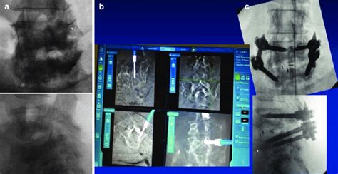 11 A Poorly Defined Anatomy On 2d Fluoroscopy Images B Pedicle