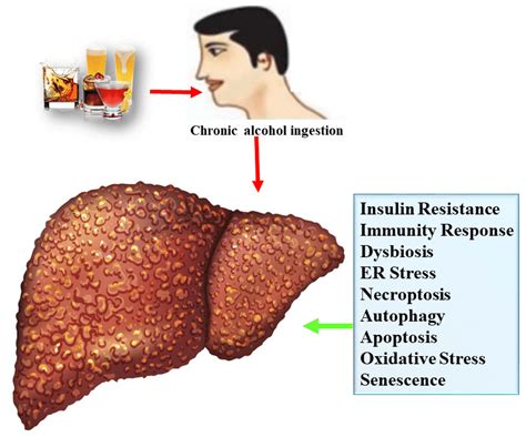 The Spectrum And Pathogenesis Of Ald Download Scientific Diagram