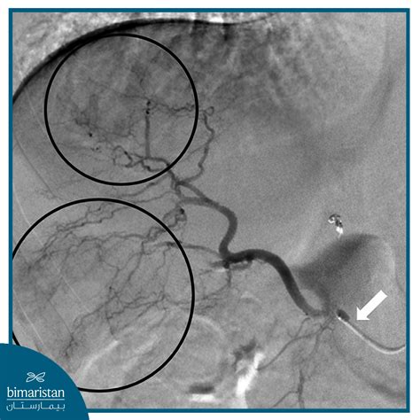 Radioembolization Everything You Need To Know In Turkey